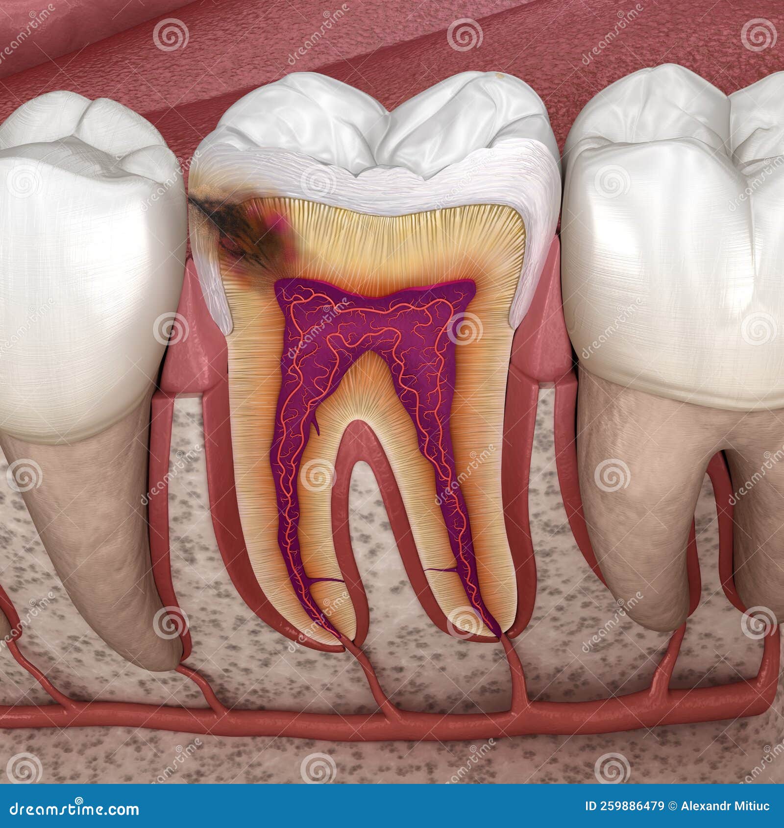 Hidden Caries in To Molar Tooth. Medically Accurate 3D Illustration ...