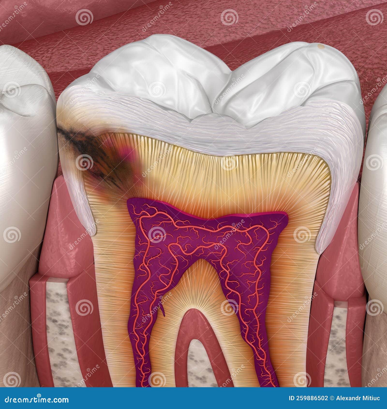 Hidden Caries in To Molar Tooth. Medically Accurate 3D Illustration ...