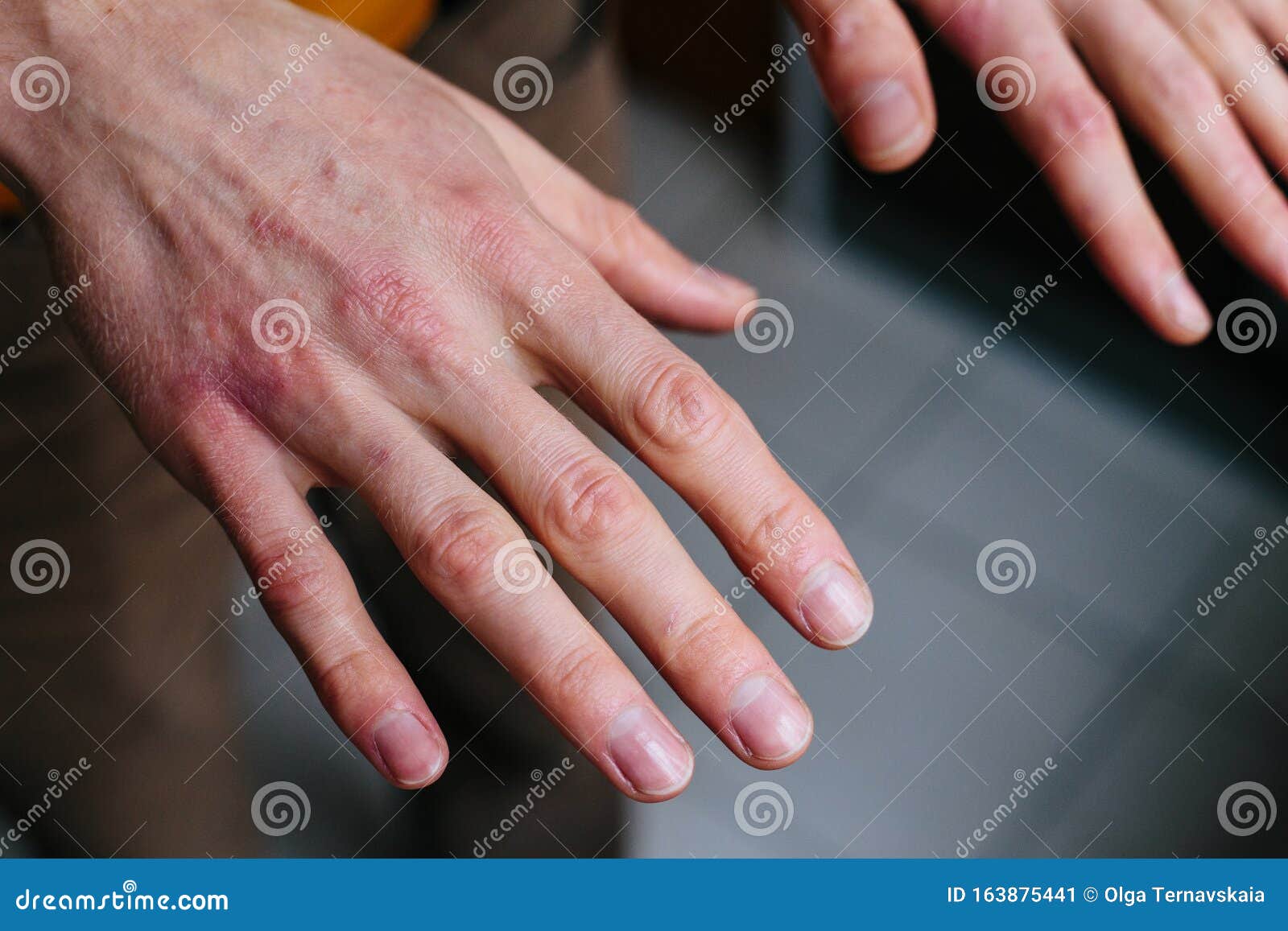 High Angle View of Hands Suffering the Dryness on the Skin and Deep ...
