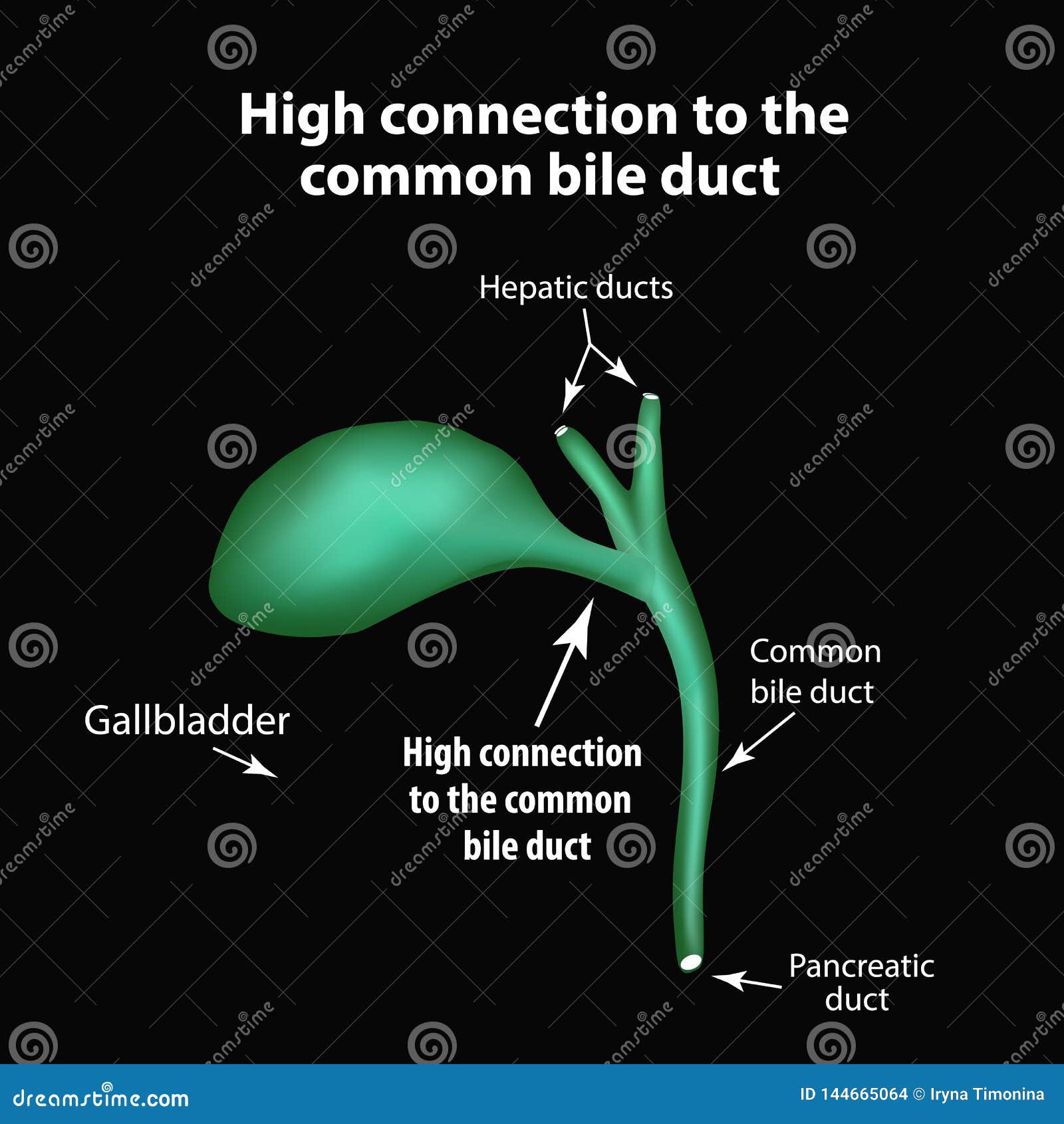 High Connection To the Common Bile Duct. Pathology of the Gallbladder ...
