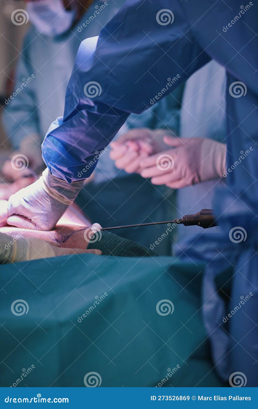 High Definition Liposuction in the Operating Room Stock Image - Image ...