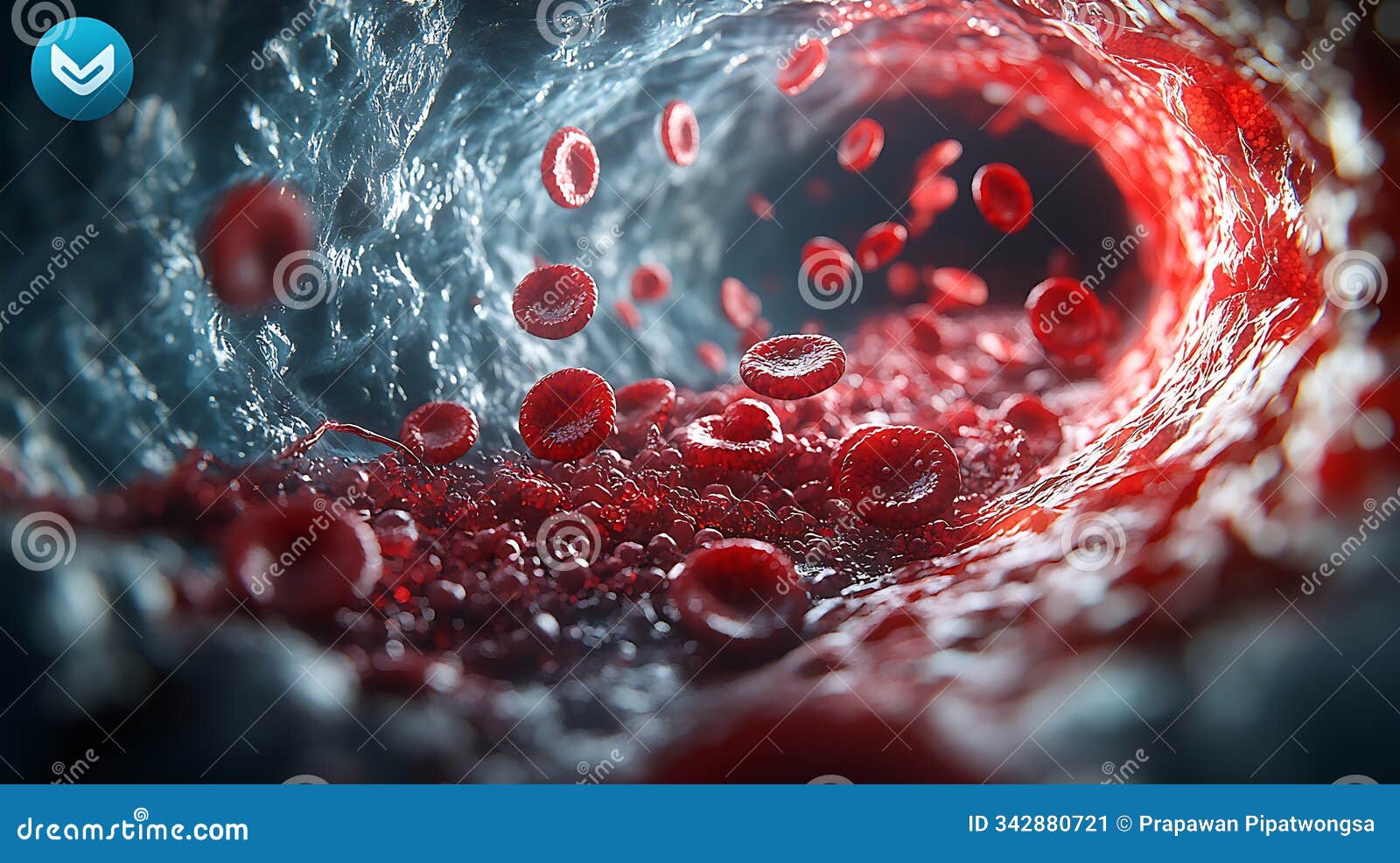 High Detail 3D Rendering of Blocked Artery Stock Illustration ...