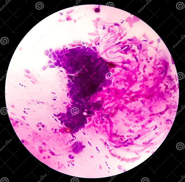 High Grade Squamous Intraepithelial Lesion Hsil Stock Image Image
