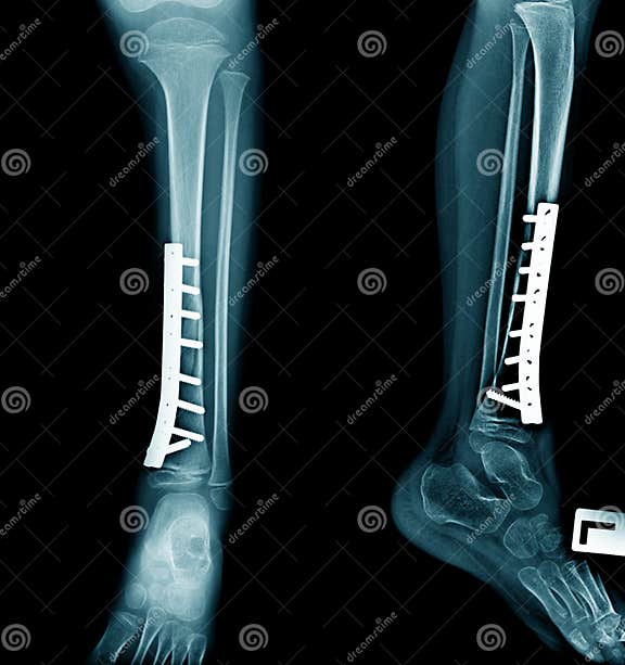 Tibia fixation x-ray stock photo. Image of foot, ankle - 115431474