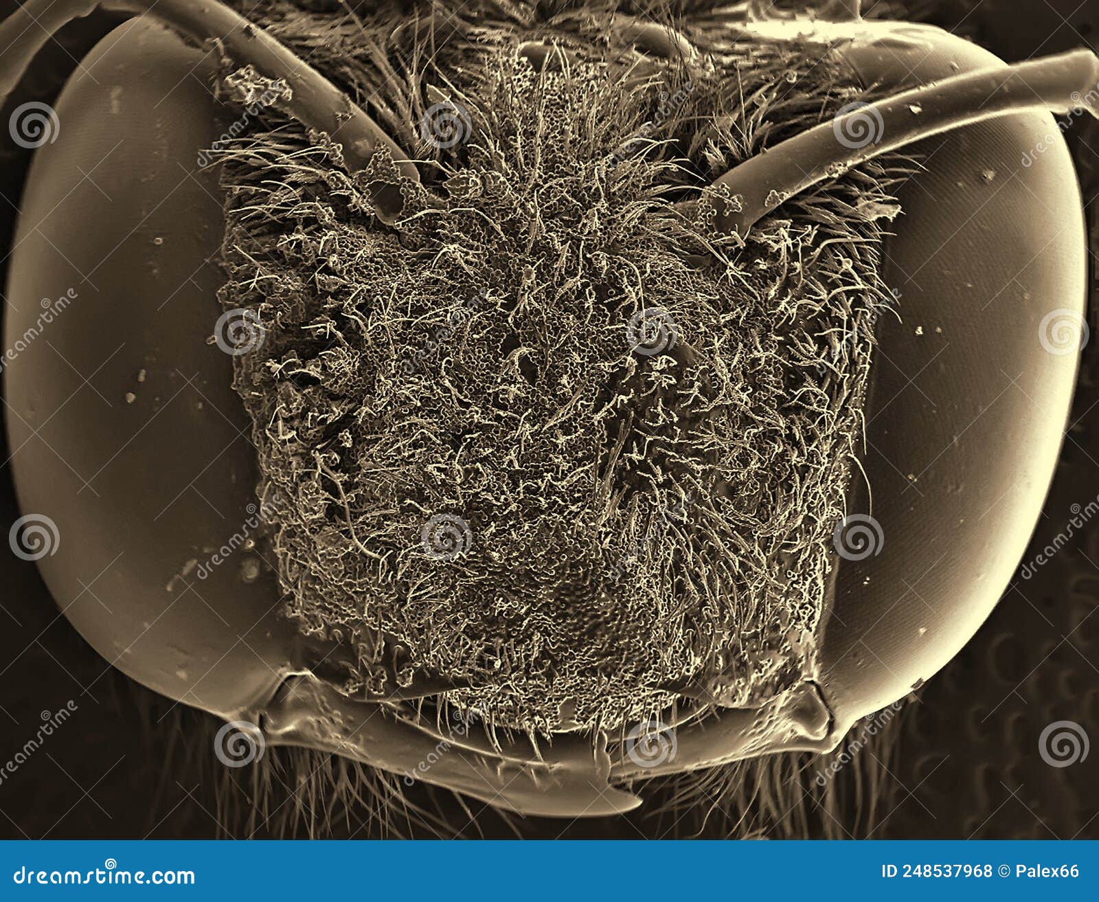 Microscope Photo Of A Large Intestine Section With Inflammation Colitis ...