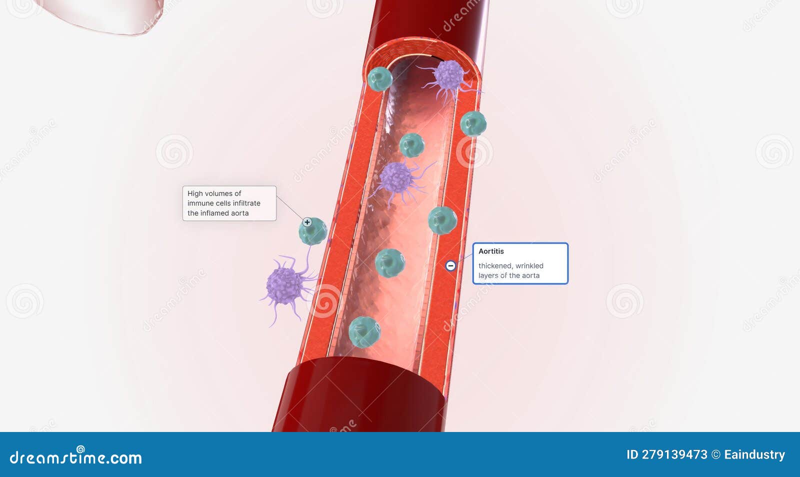 High Volumes of Lymphocytes, Macrophages, and Other Immune Cells ... High Volumes of Lymphocytes, Macrophages, and Other Immune Cells ...