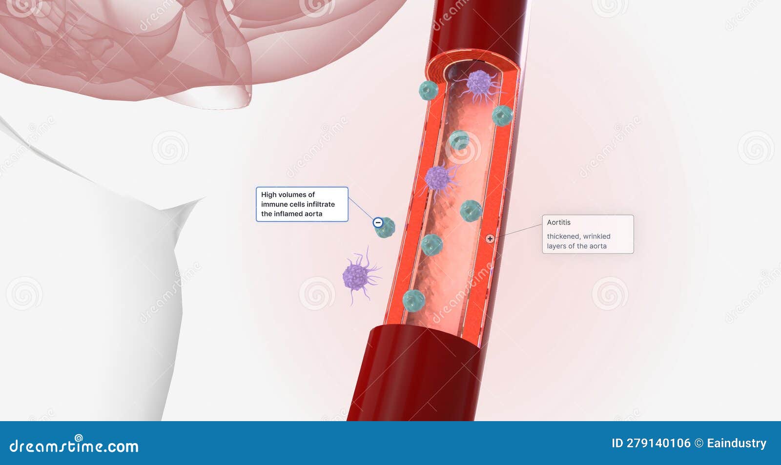 High Volumes of Lymphocytes, Macrophages, and Other Immune Cells ... High Volumes of Lymphocytes, Macrophages, and Other Immune Cells ...