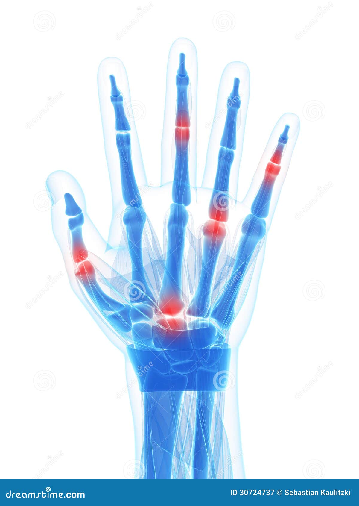 Highlighted Arthritic Hand Royalty-Free Illustration | CartoonDealer ...