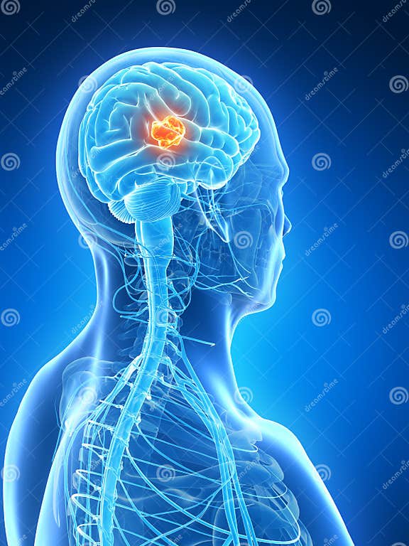 Highlighted brain tumor stock illustration. Illustration of brain ...