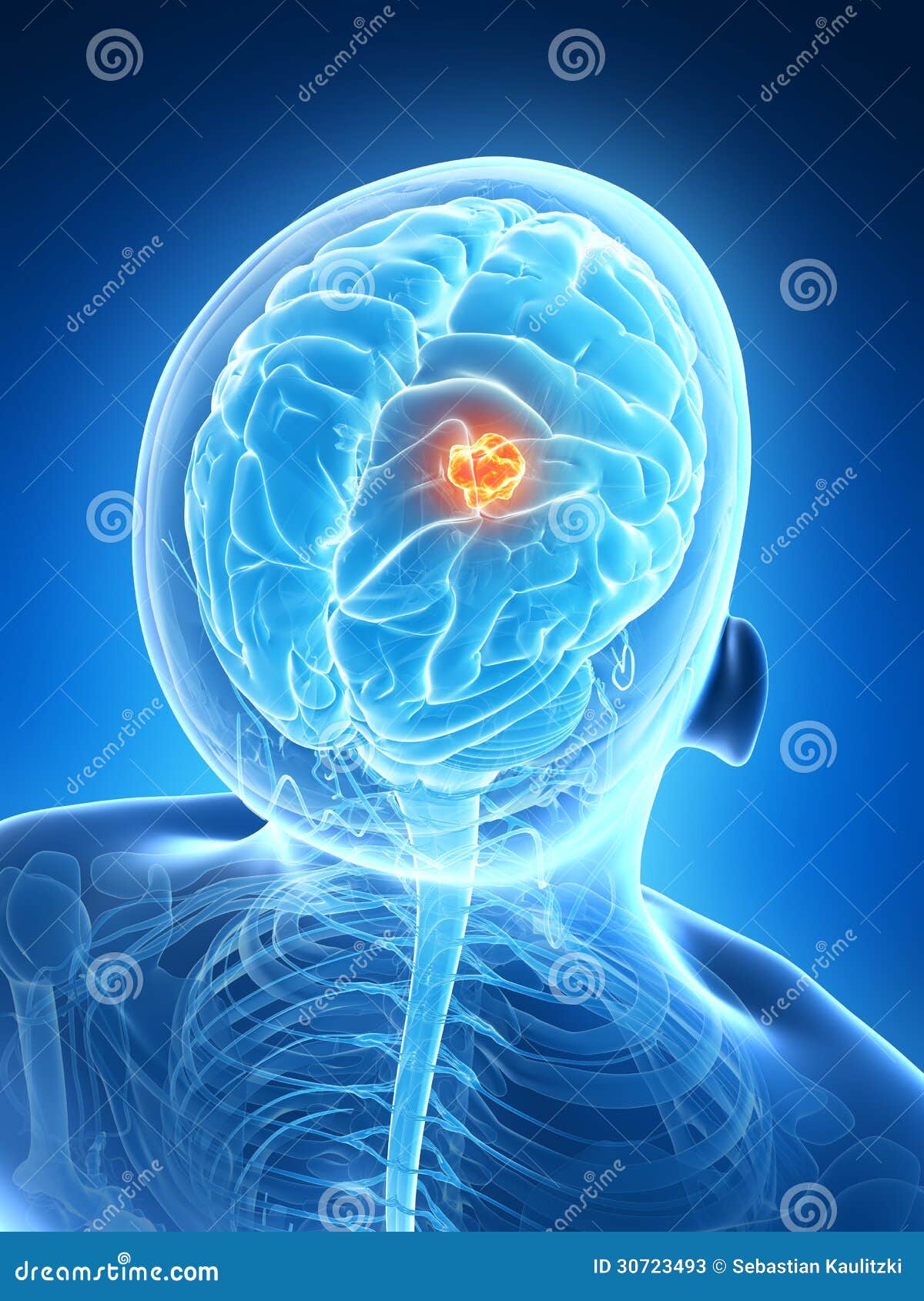 Highlighted brain tumor stock illustration. Illustration of scan - 30723493