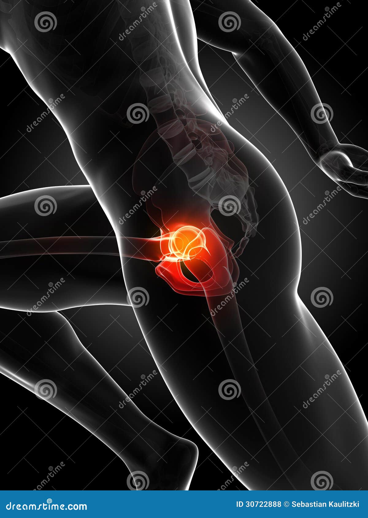 Highlighted hip joint stock illustration. Illustration of arthritis ...