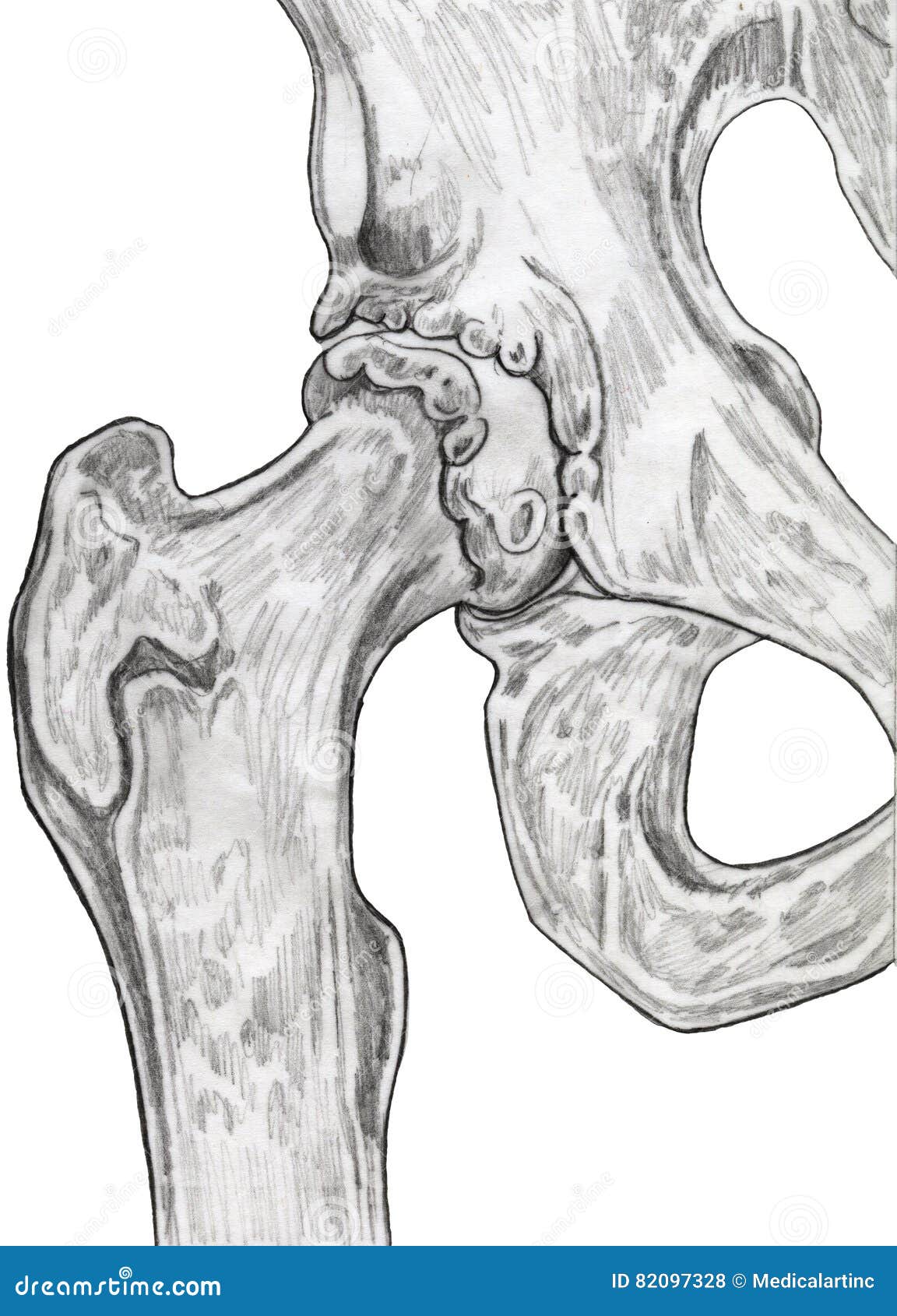 Hip - Bones Arthritis stock illustration. Illustration of foramen ...
