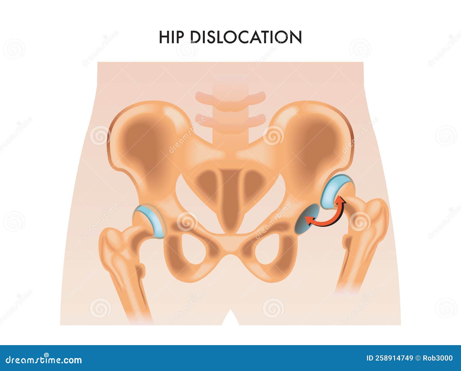 Hip Dislocation Illustration Stock Vector - Illustration of care, dislocated: 258914749