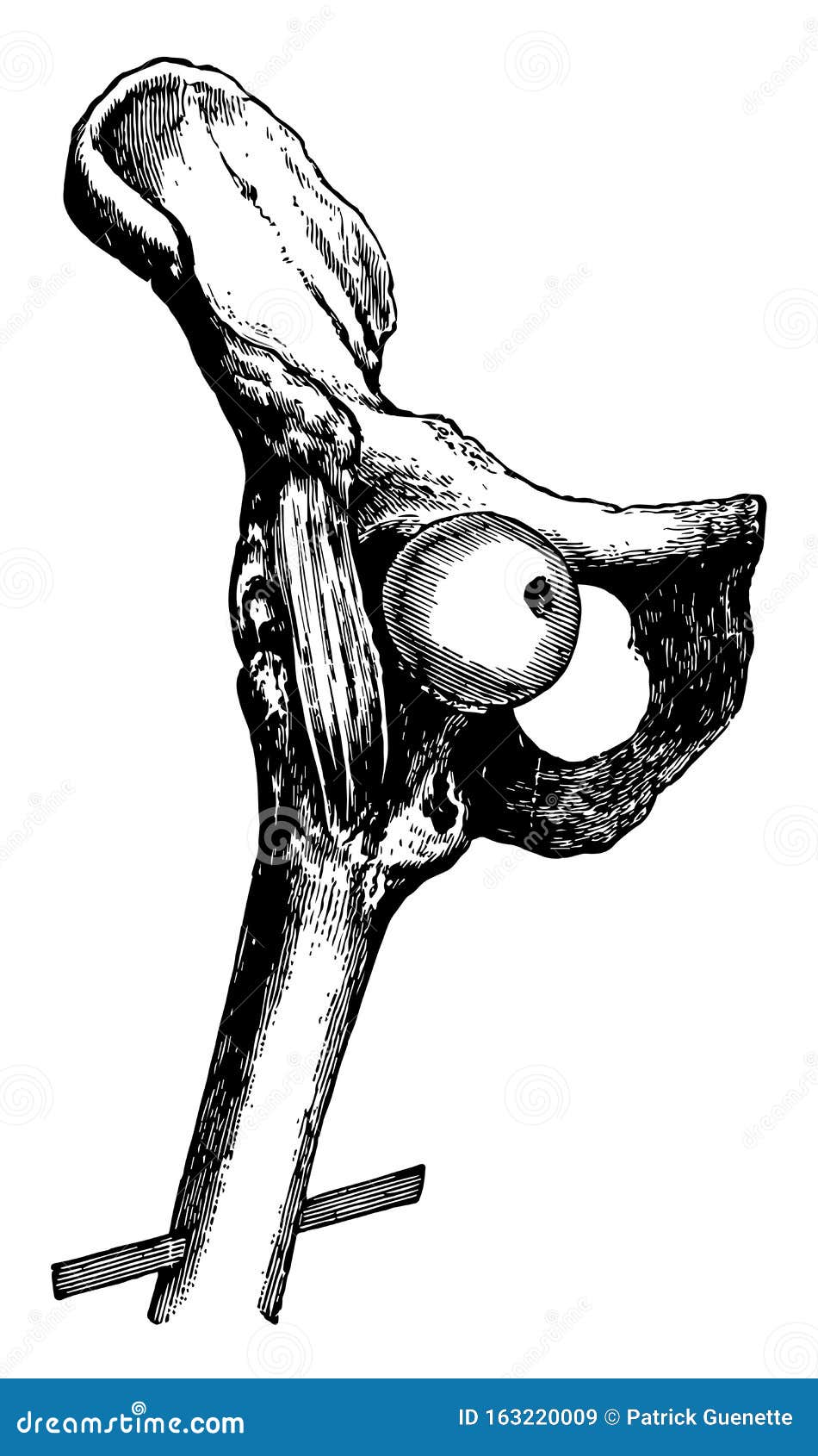 Hip Dislocation upon the Pubes, Vintage Illustration Stock Vector ...