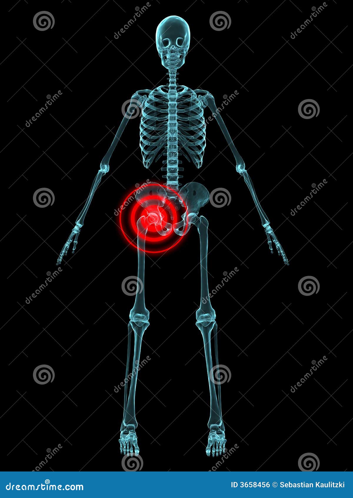 Hip joint inflammation stock illustration. Illustration of osteoporosis ...