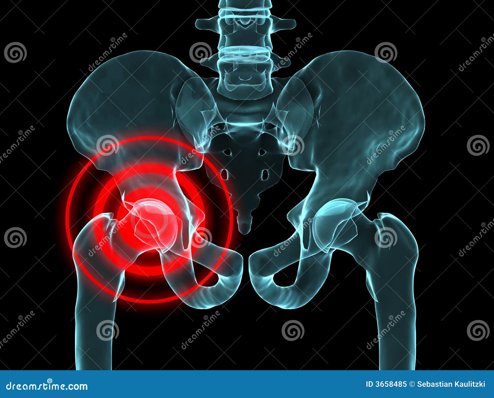Hip joint inflammation stock illustration. Illustration of skull - 3658485