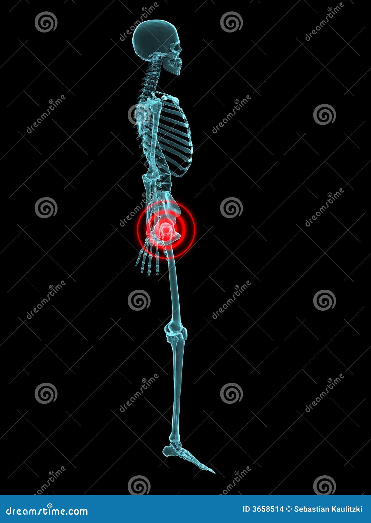 Hip joint inflammation stock illustration. Illustration of backbone ...