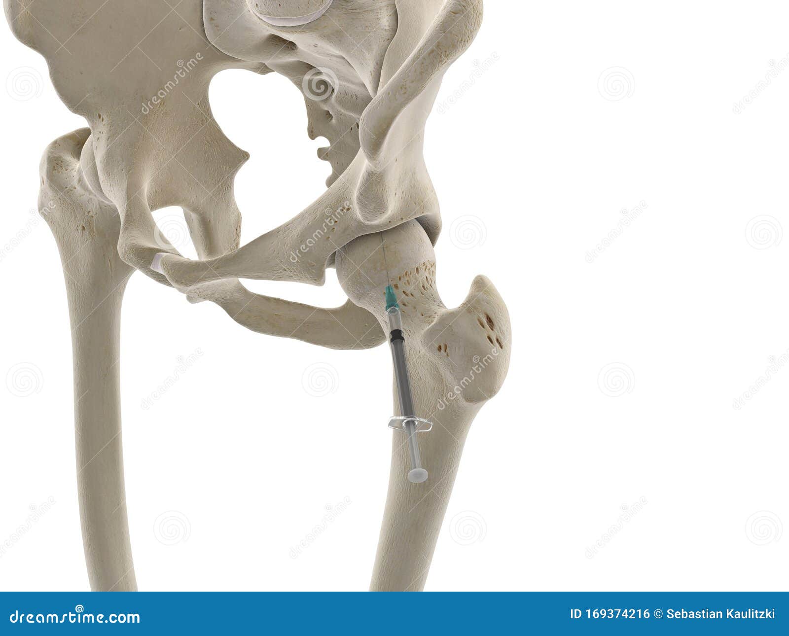 A hip joint injection stock illustration. Illustration of human - 169374216