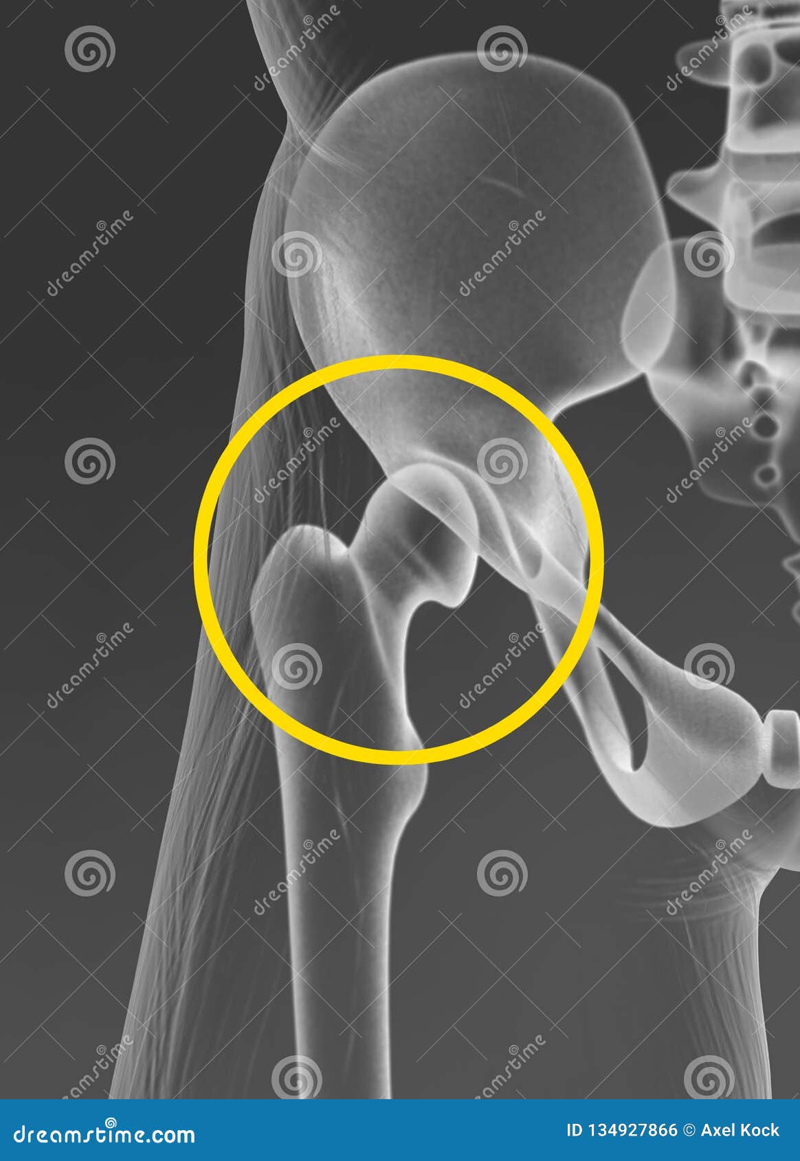 Hip Joint, Pelvis, Medically Artwork Stock Illustration - Illustration ...