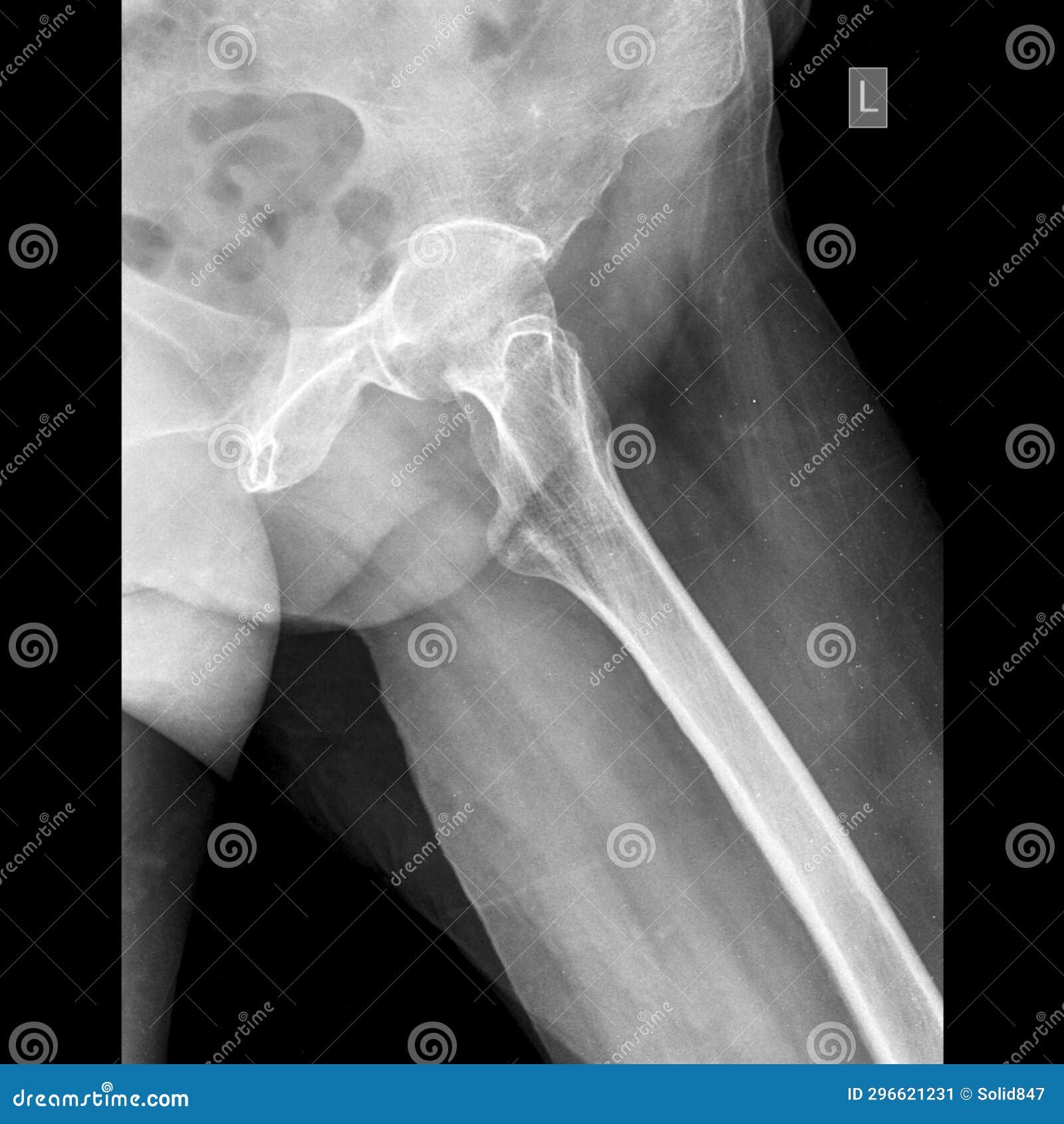 Hip Joint X-ray Image Lateral View Royalty-Free Stock Photography ...