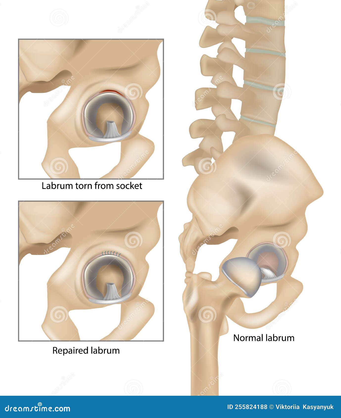 Hip Labral Tears. Labrum Torn From Socket And Repaired Labrum. Surgery ...