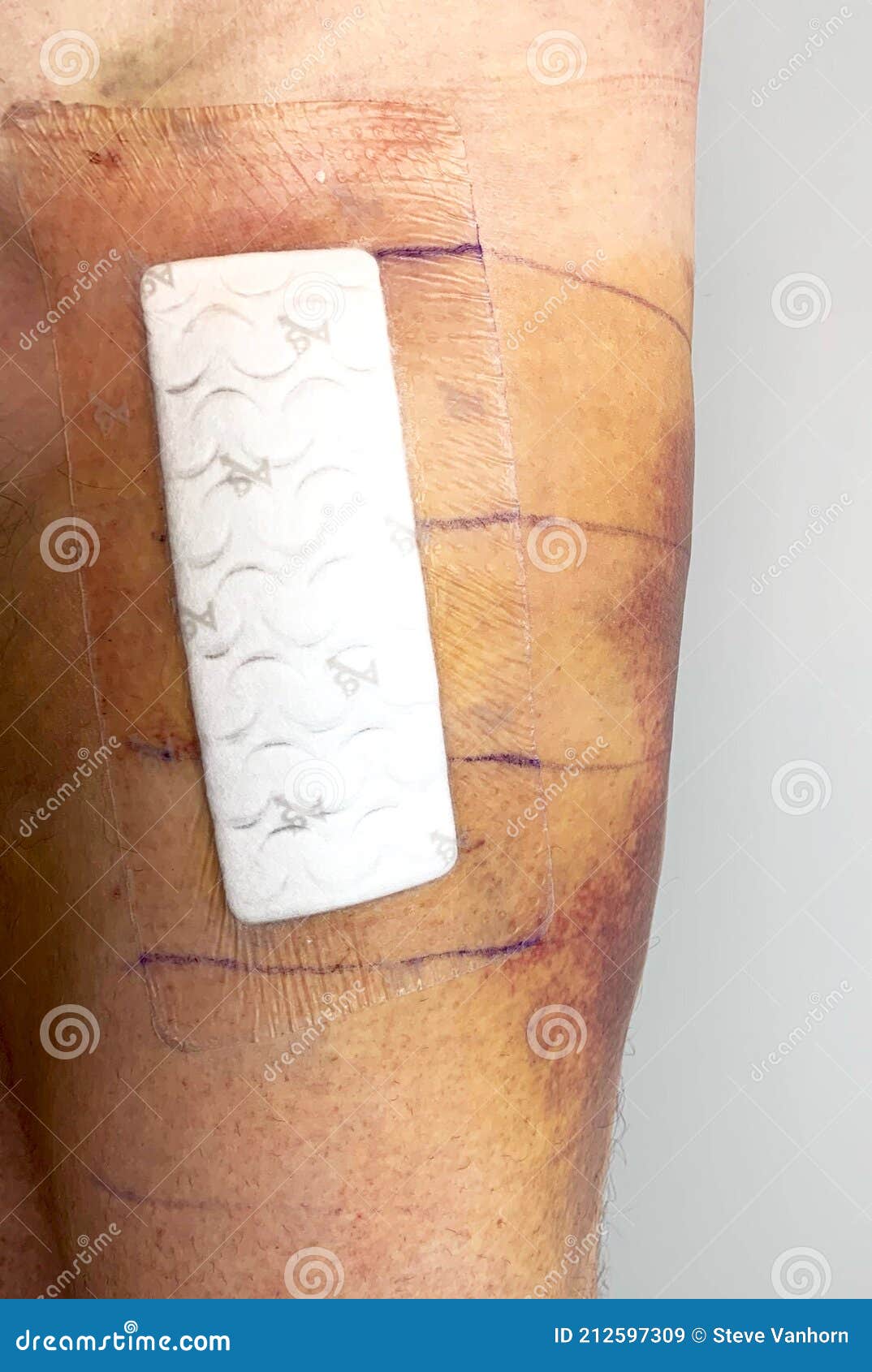 Hip replacement bruise stock image. Image of replacement - 212597309