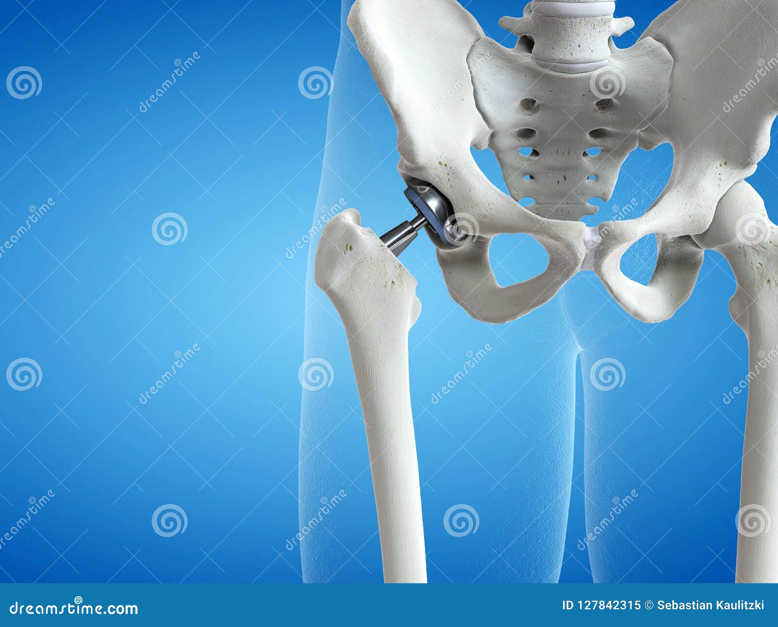 A hip replacement stock illustration. Illustration of cartilage - 127842315