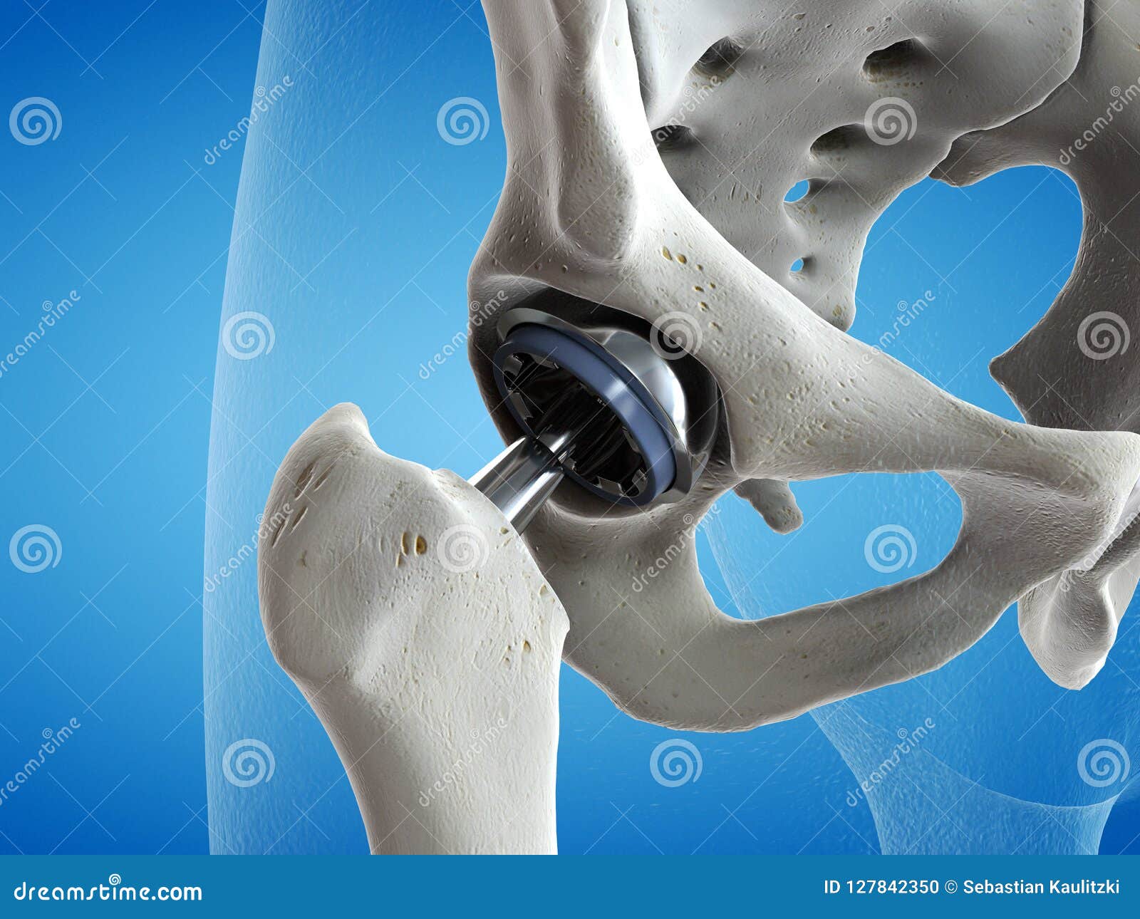 A hip replacement stock illustration. Illustration of orthopedics ...