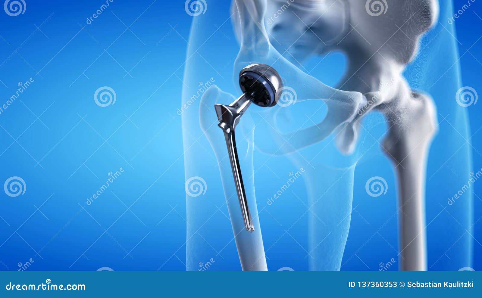 A hip replacement stock illustration. Illustration of pelvic - 137360353