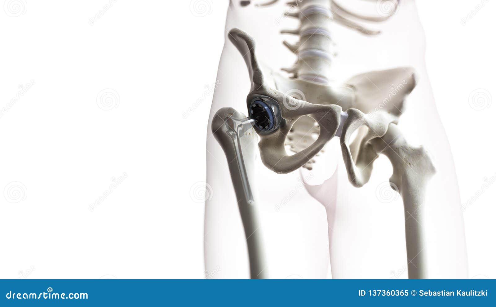 A hip replacement stock illustration. Illustration of inside - 137360365