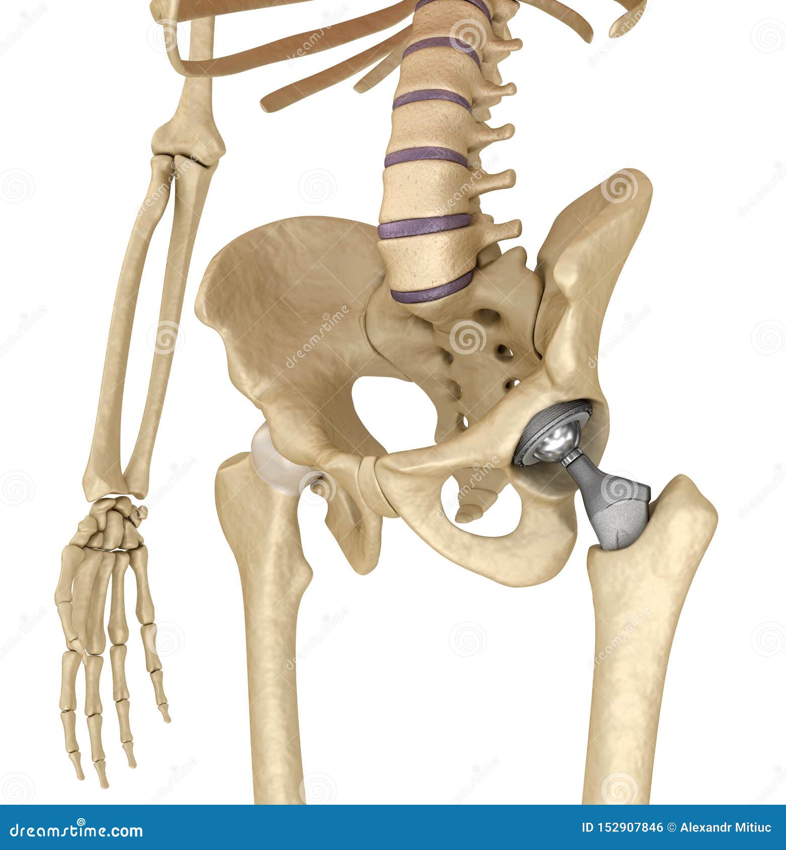 Hip Replacement Implant Installed In The Pelvis Bone. X-ray View ...