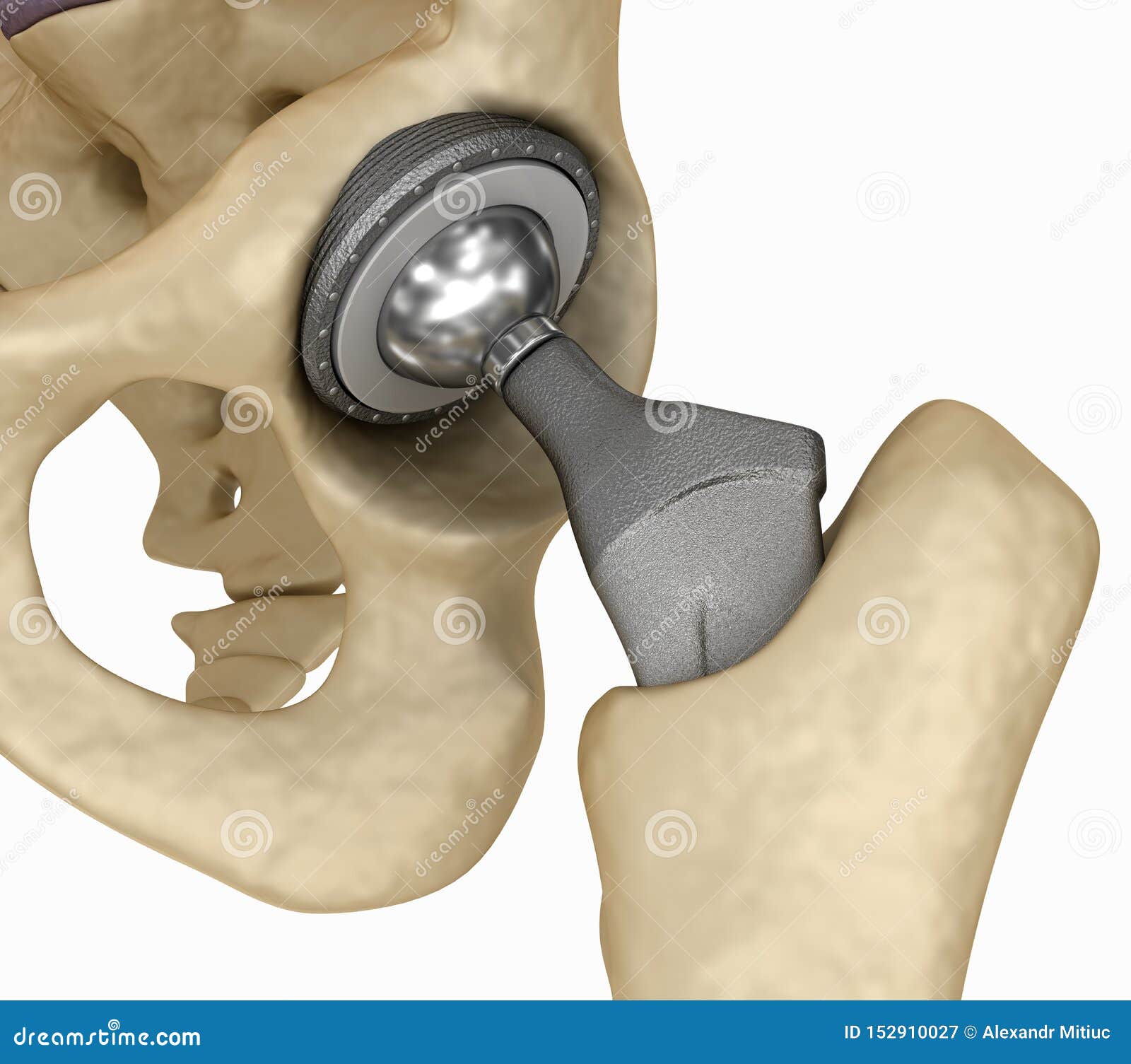 Hip Replacement Implant Installed in the Pelvis Bone. Stock ...