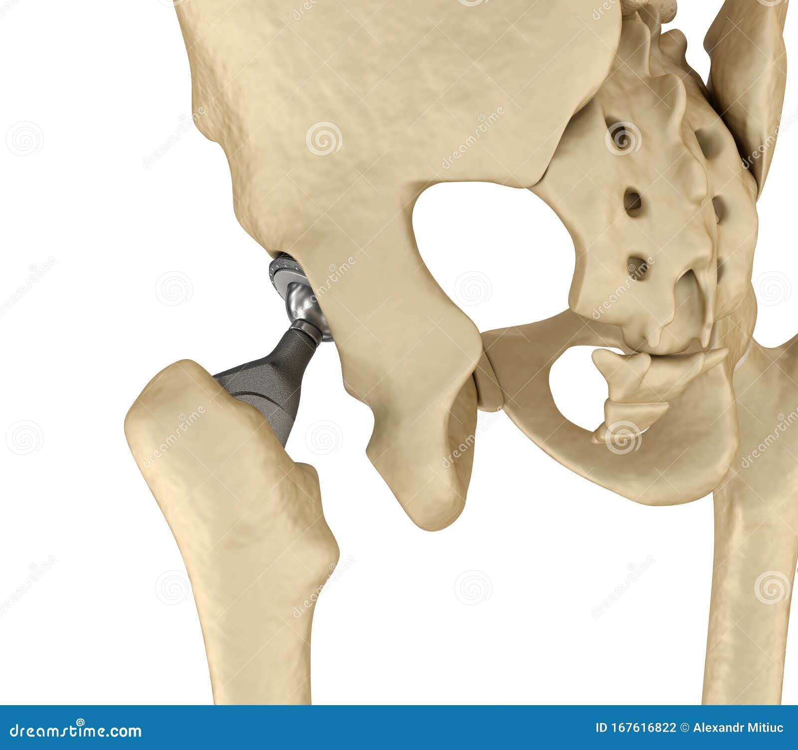 Hip Replacement Implant Installed in the Pelvis Bone. Medically ...
