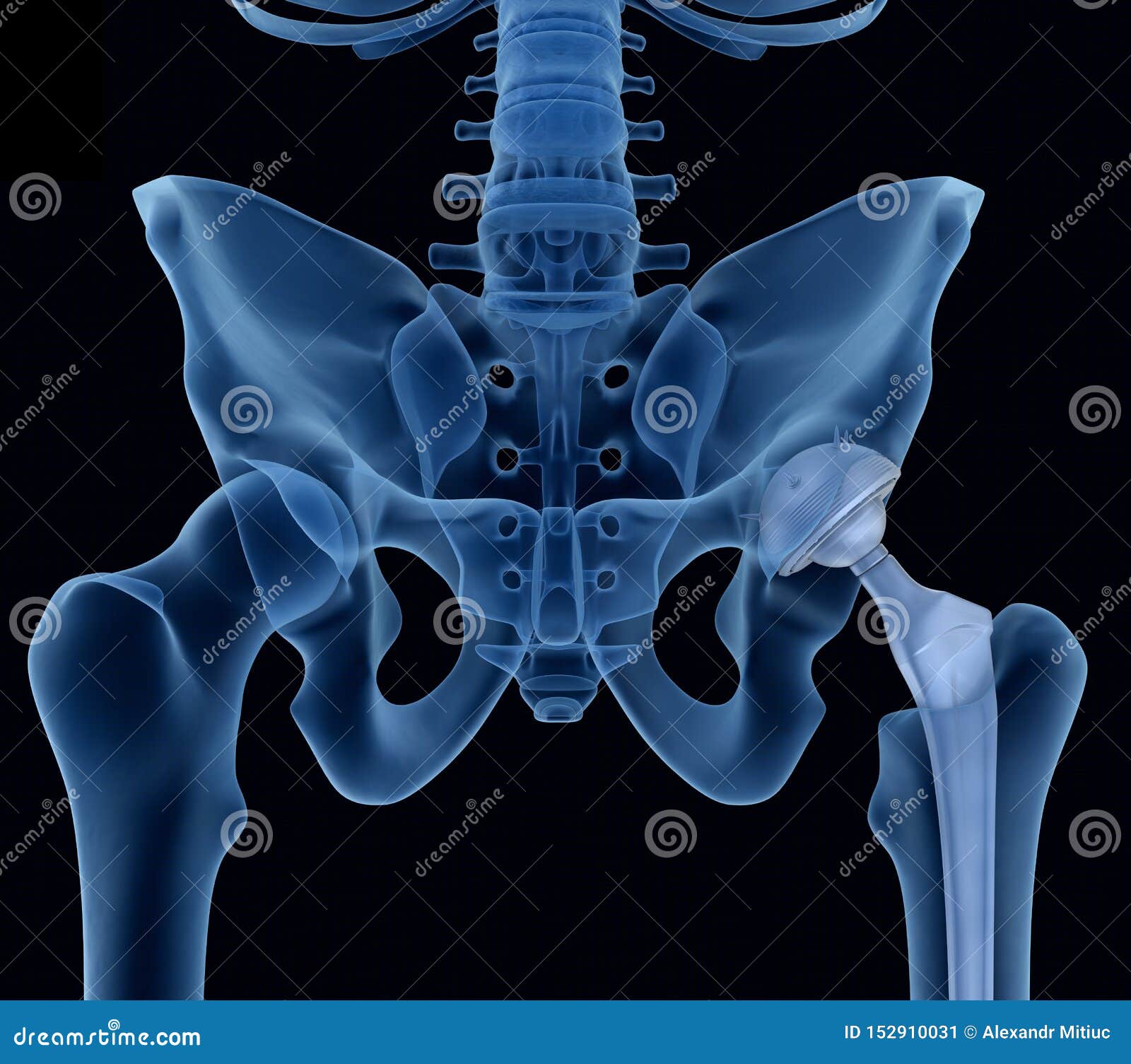 Hip Replacement Implant Installed in the Pelvis Bone. X-ray View Stock ...