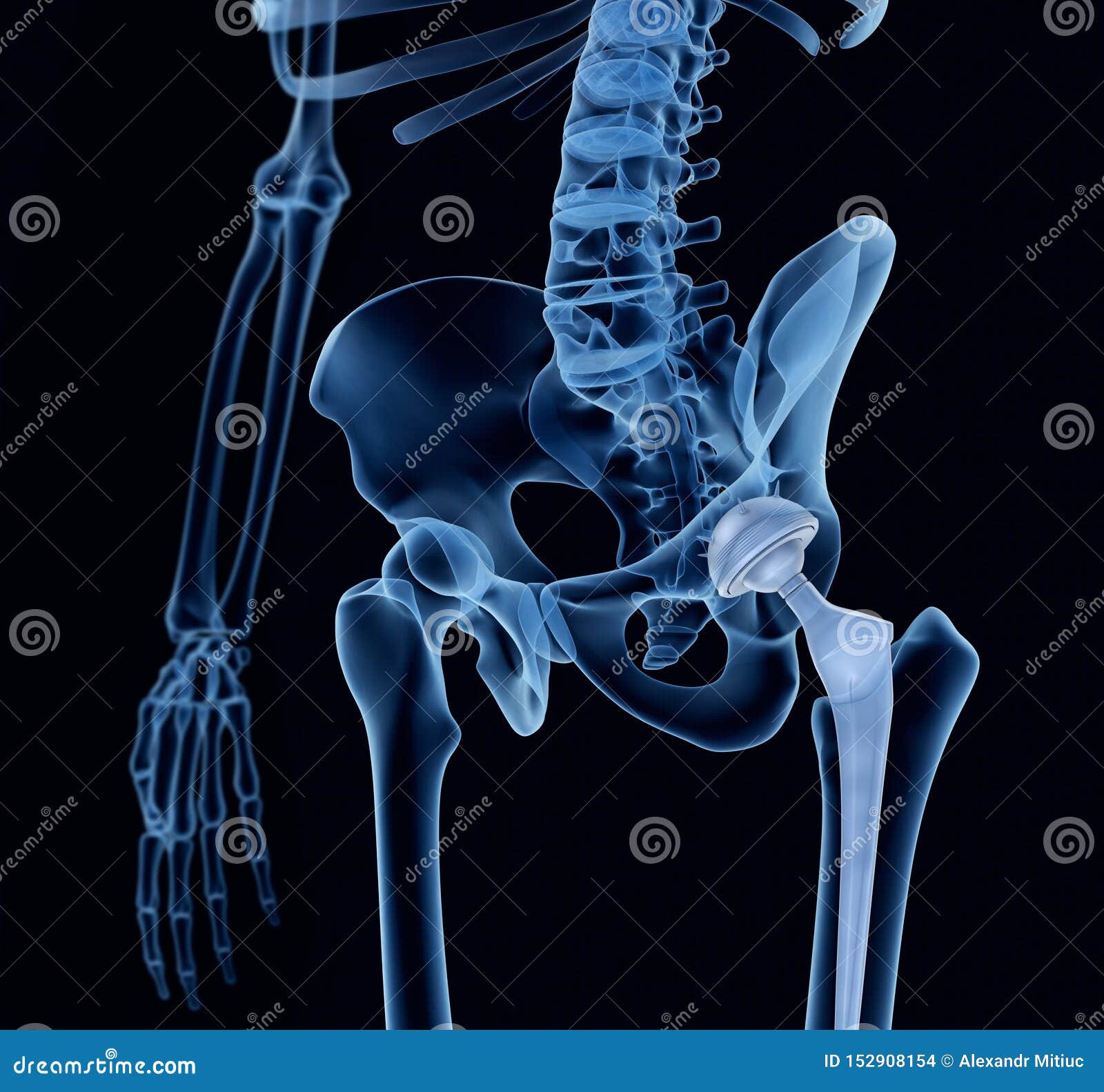 Hip Replacement Implant Installed In The Pelvis Bone. X-ray View. Stock ...