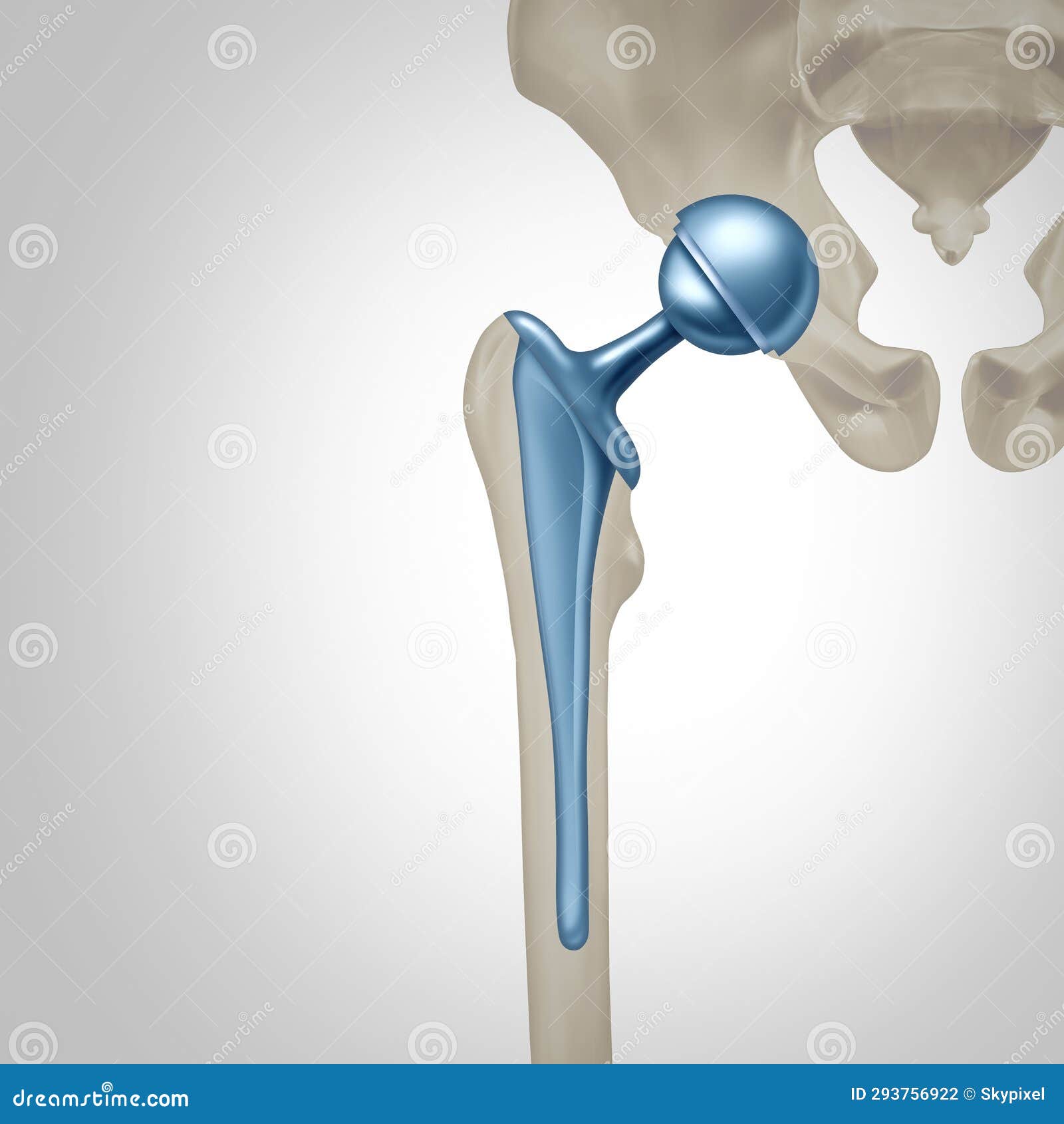 Hip Replacement Surgery stock illustration. Illustration of joint ...