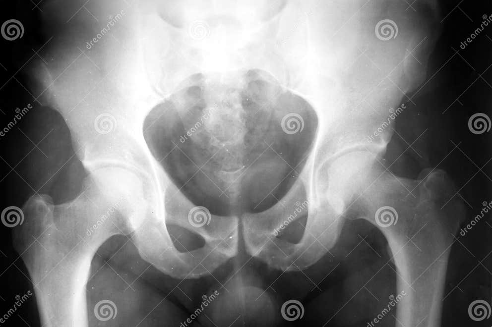 Hip xray stock image. Image of physician, diagnosis, rontgen - 23835025