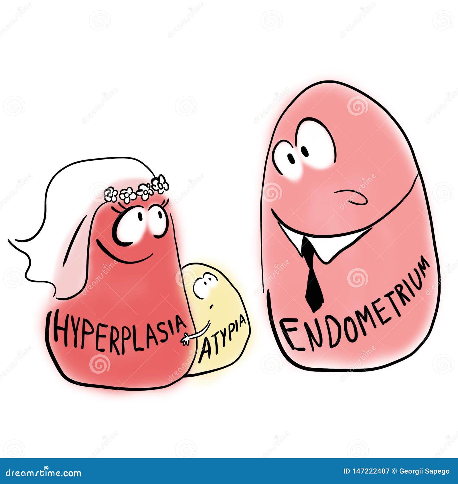 Hiperplasia Endometrial Com Atypia Tipo De Hiperplasia Ilustração Stock ...