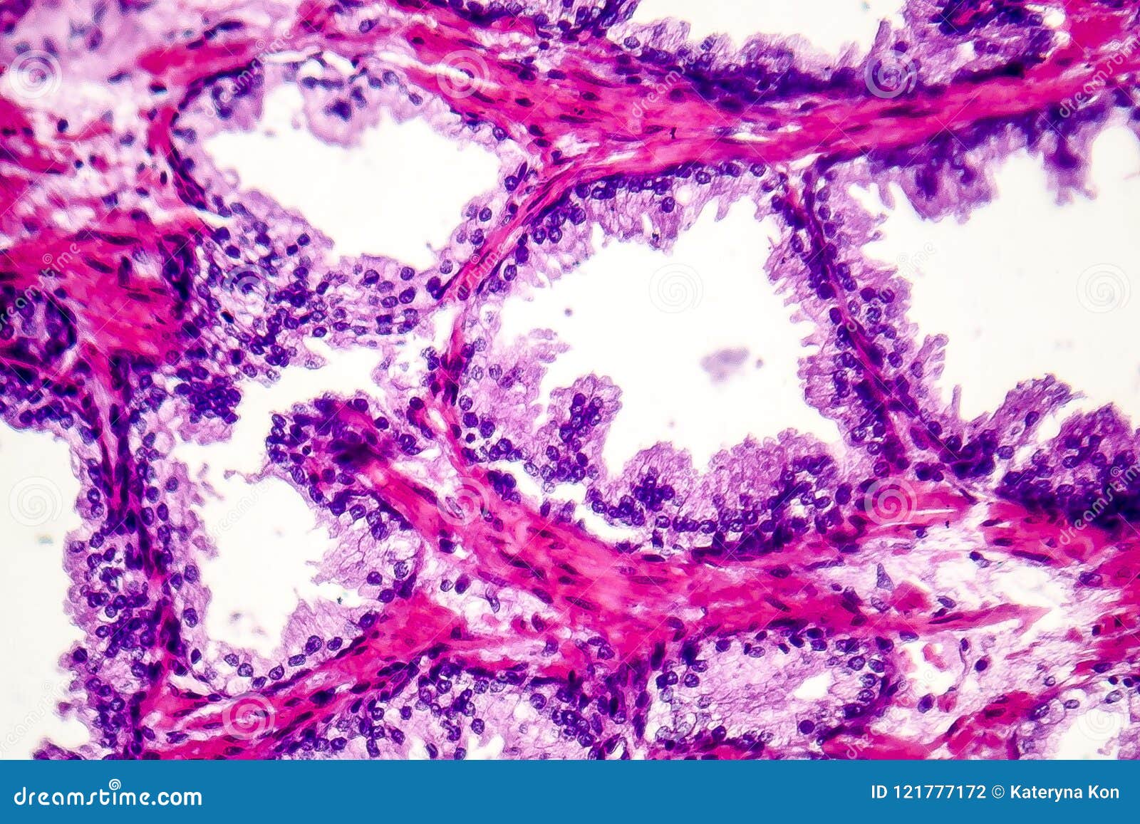 Hiperplasia Prostática Benigna Foto de archivo - Imagen de laboratorio ...