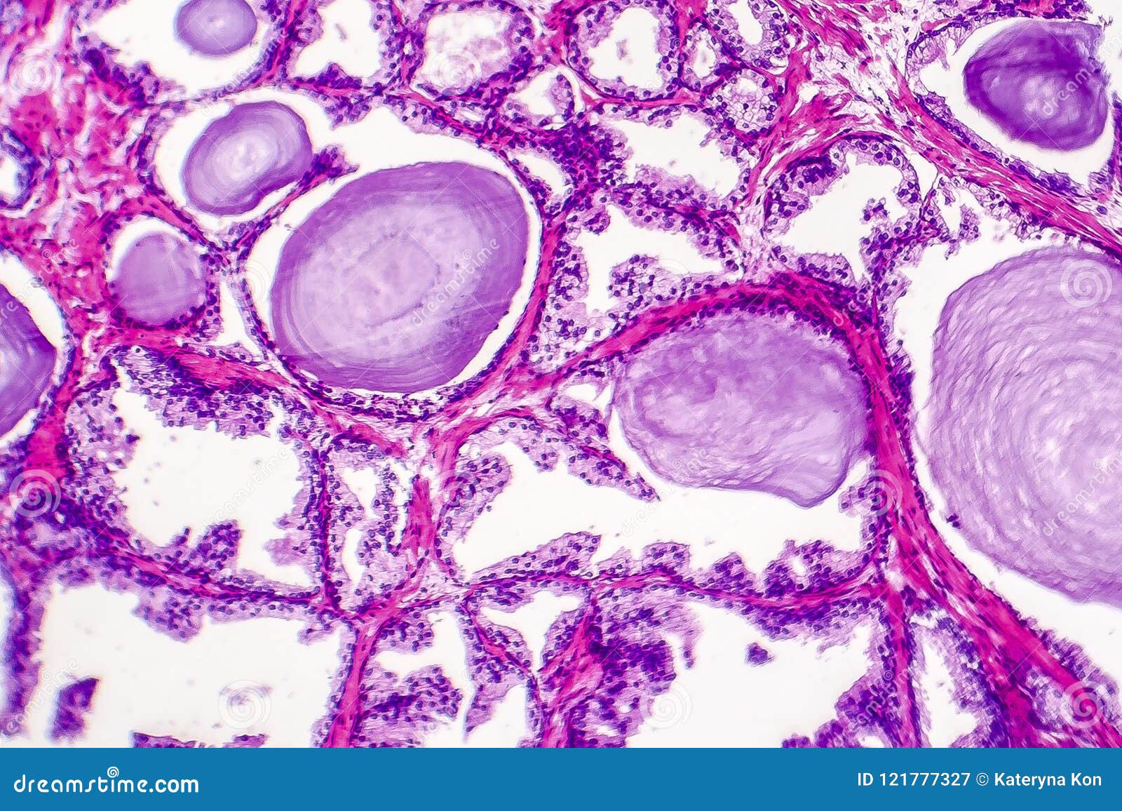 Hiperplasia Prostática Benigna Imagen de archivo - Imagen de ...