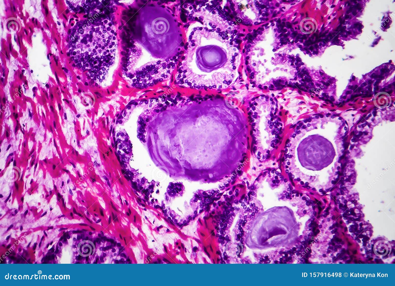 Hiperplasia ProstÃ¡tica Benigna Foto de archivo - Imagen de tejido ...