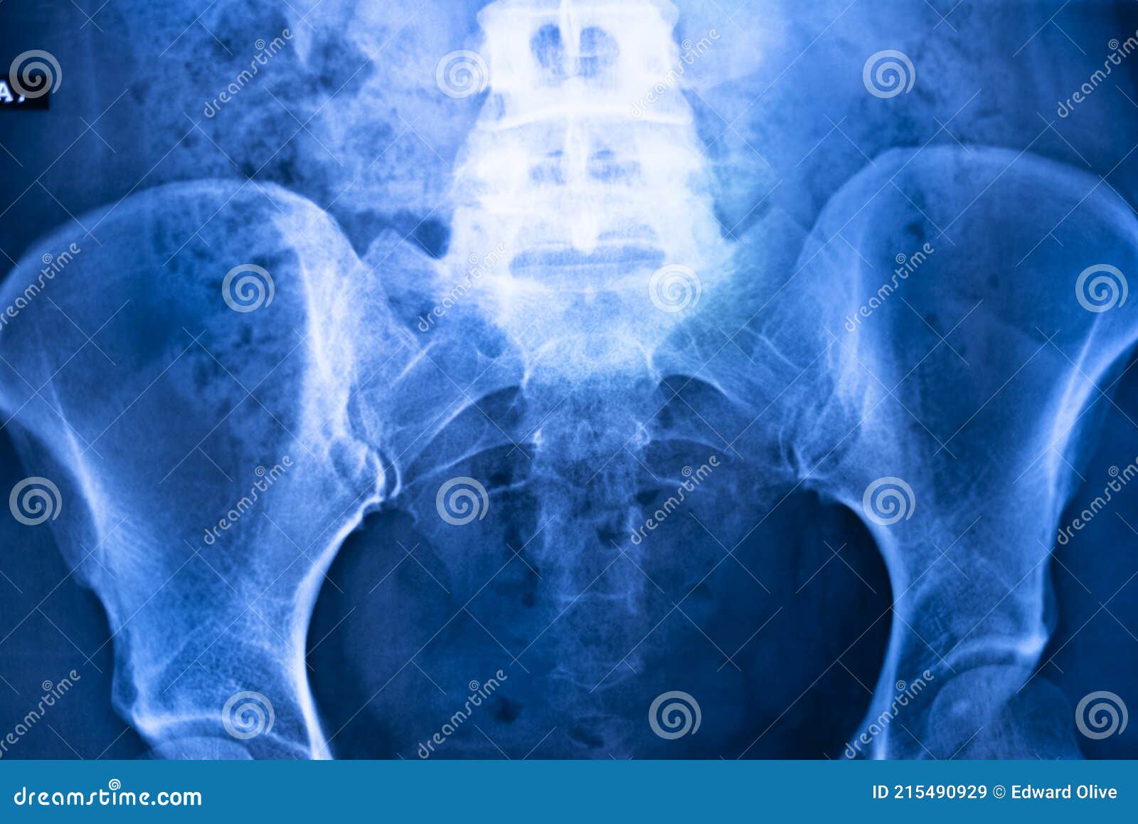 Hips pelvis xray scan stock image. Image of pelvic, lumbar - 215490929