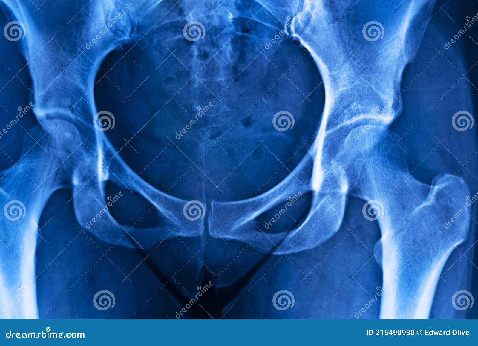 Hips pelvis xray scan stock photo. Image of pelvic, radiography - 215490930