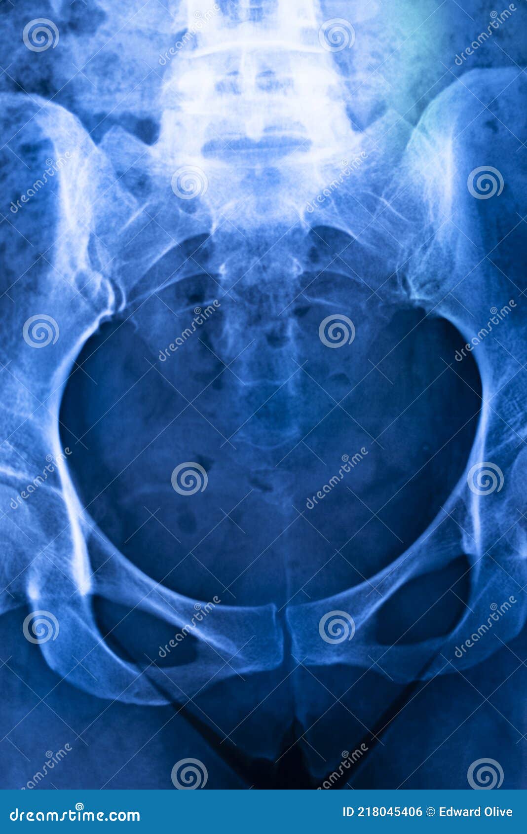 CT-scan 3D Pelvis Royalty-Free Stock Photography | CartoonDealer.com ...