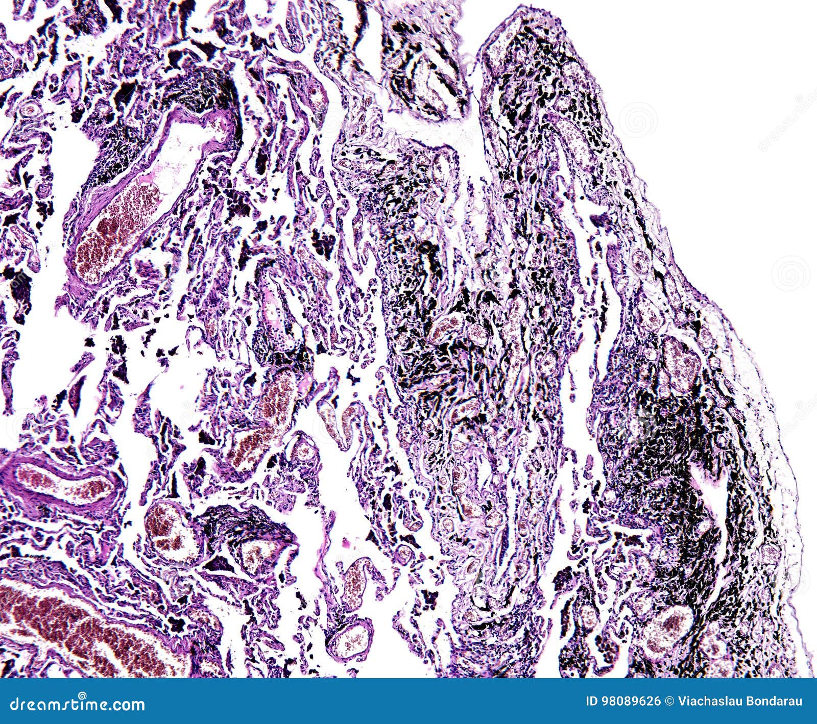 Histology of Human Tissue, Show Lung of Smoking As Seen Under the ...