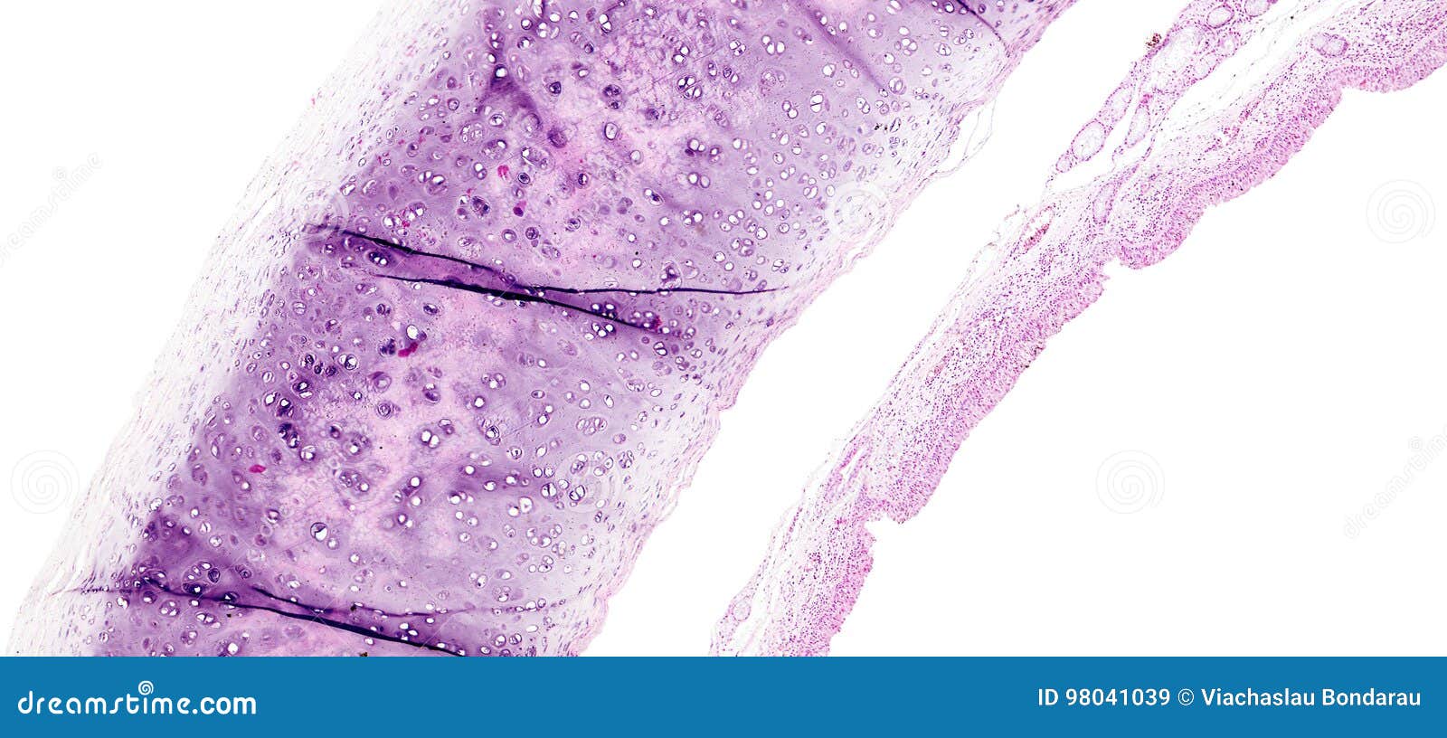 Histology of Human Tissue, Show Tracheitis As Seen Under the Microscope ...