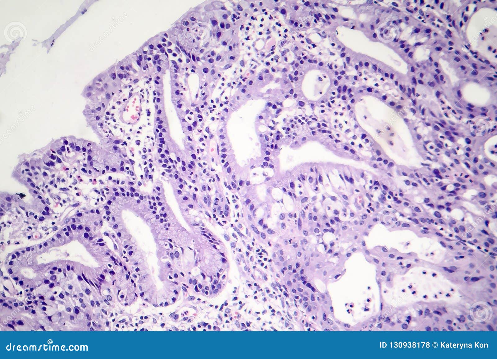 Histopathologie Des Polypes Nasaux Photo stock - Image du médecine ...