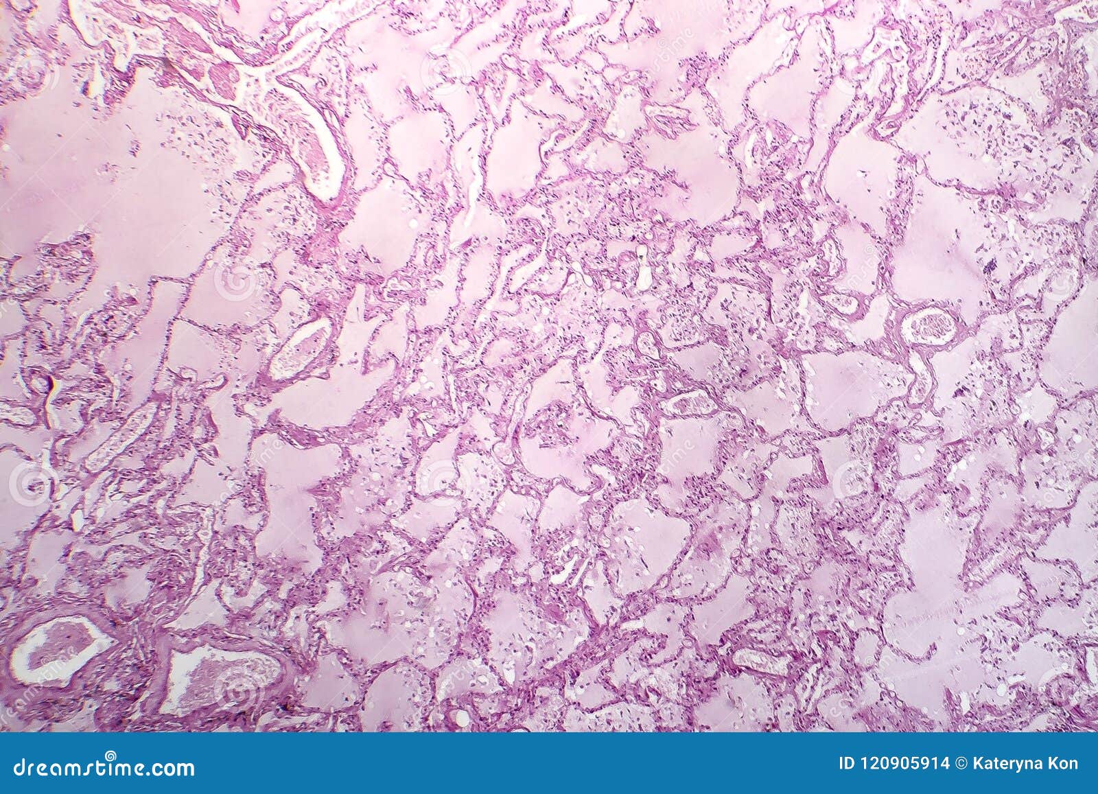 Acute Pulmonary Edema Stock Image | CartoonDealer.com #120906763