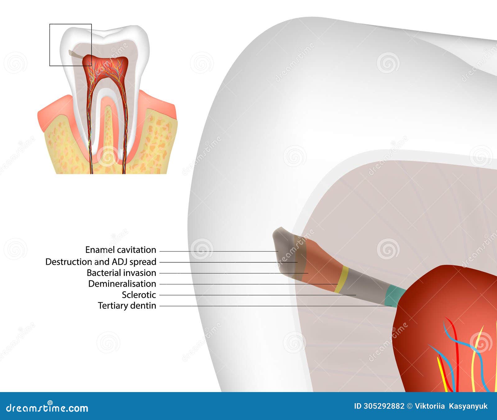 Dentin Or Dentine Is A Calcified Tissue Of The Body. Dentinal Tubules ...