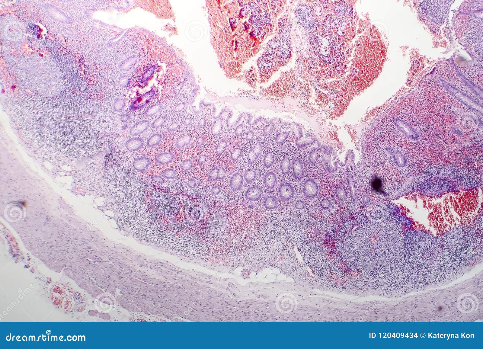 Histopathology of Chronic Appendicitis Stock Photo - Image of ...